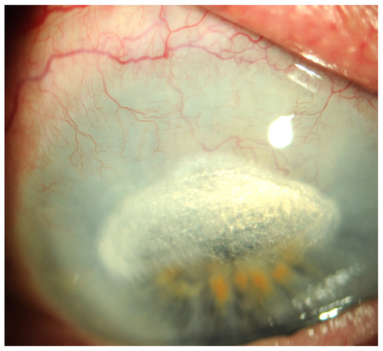 Available Therapeutic Options for Corneal Neovascularization: A Review