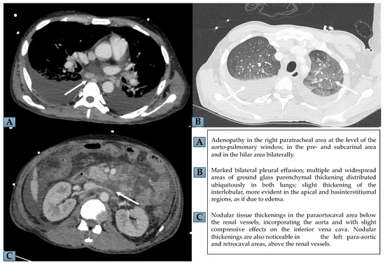 Pathogenesis of Hemophagocytic Lymphohistiocytosis/Macrophage ...