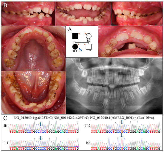 AMELX Mutations and Genotype–Phenotype Correlation in X-Linked ...