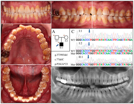 AMELX Mutations and Genotype–Phenotype Correlation in X-Linked ...