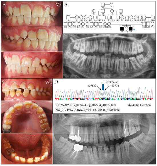 AMELX Mutations and Genotype–Phenotype Correlation in X-Linked ...