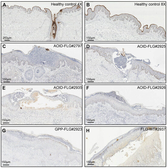 Rare Filaggrin Variants Are Associated with Pustular Skin Diseases in ...