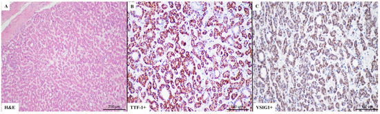 Gastric-Type Expression Signature in Hepatocellular Carcinoma