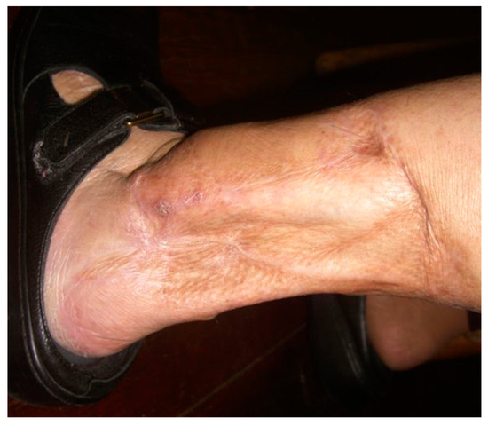 Cutaneous Wound Healing and the Effects of Cannabidiol