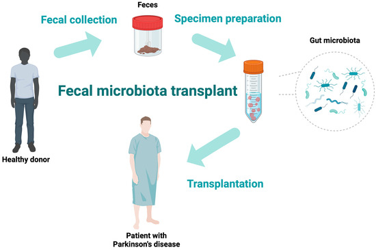 Exploring Fecal Microbiota Transplantation for Modulating Inflammation in Parkinson’s Disease: A ...