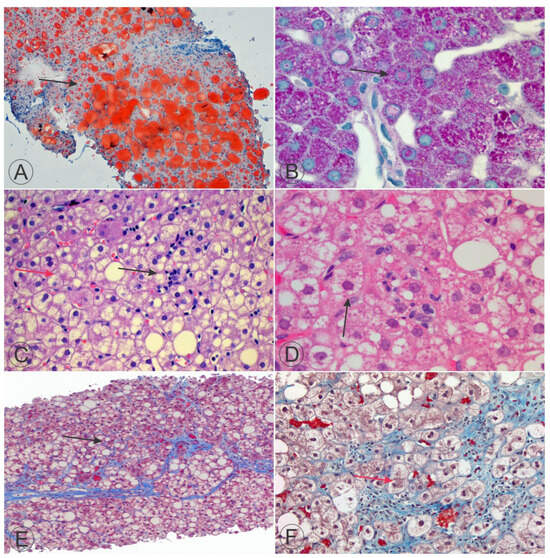 NAFLD (MASLD)/NASH (MASH): Does It Bother to Label at All? A ...