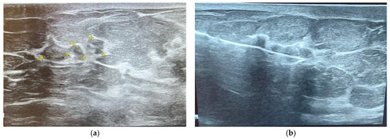 Correlations of Imaging and Therapy in Breast Cancer Based on Molecular ...