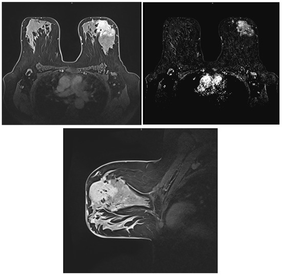 Correlations of Imaging and Therapy in Breast Cancer Based on Molecular ...