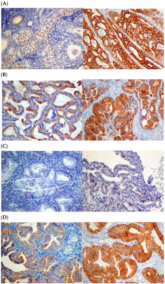 Expression Patterns of Cytokeratins (CK7, CK20, CK19, CK AE1/AE3) in Atypical Endometrial ...