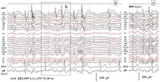 IJMS | Free Full-Text | Automatic Detection of the EEG Spike–Wave ...