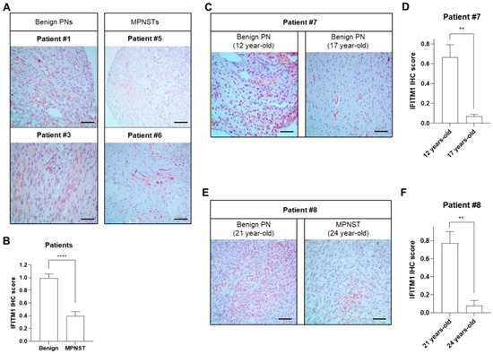 IJMS | Free Full-Text | Interferon-Induced Transmembrane Protein 1 ...