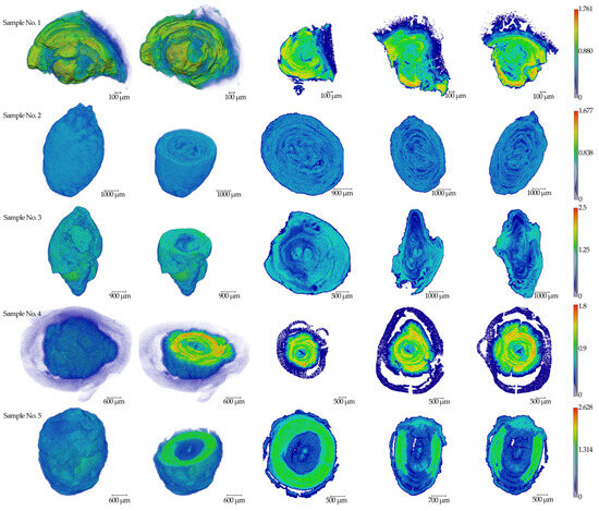 The Role of Metal Nanoparticles in the Pathogenesis of Stone Formation