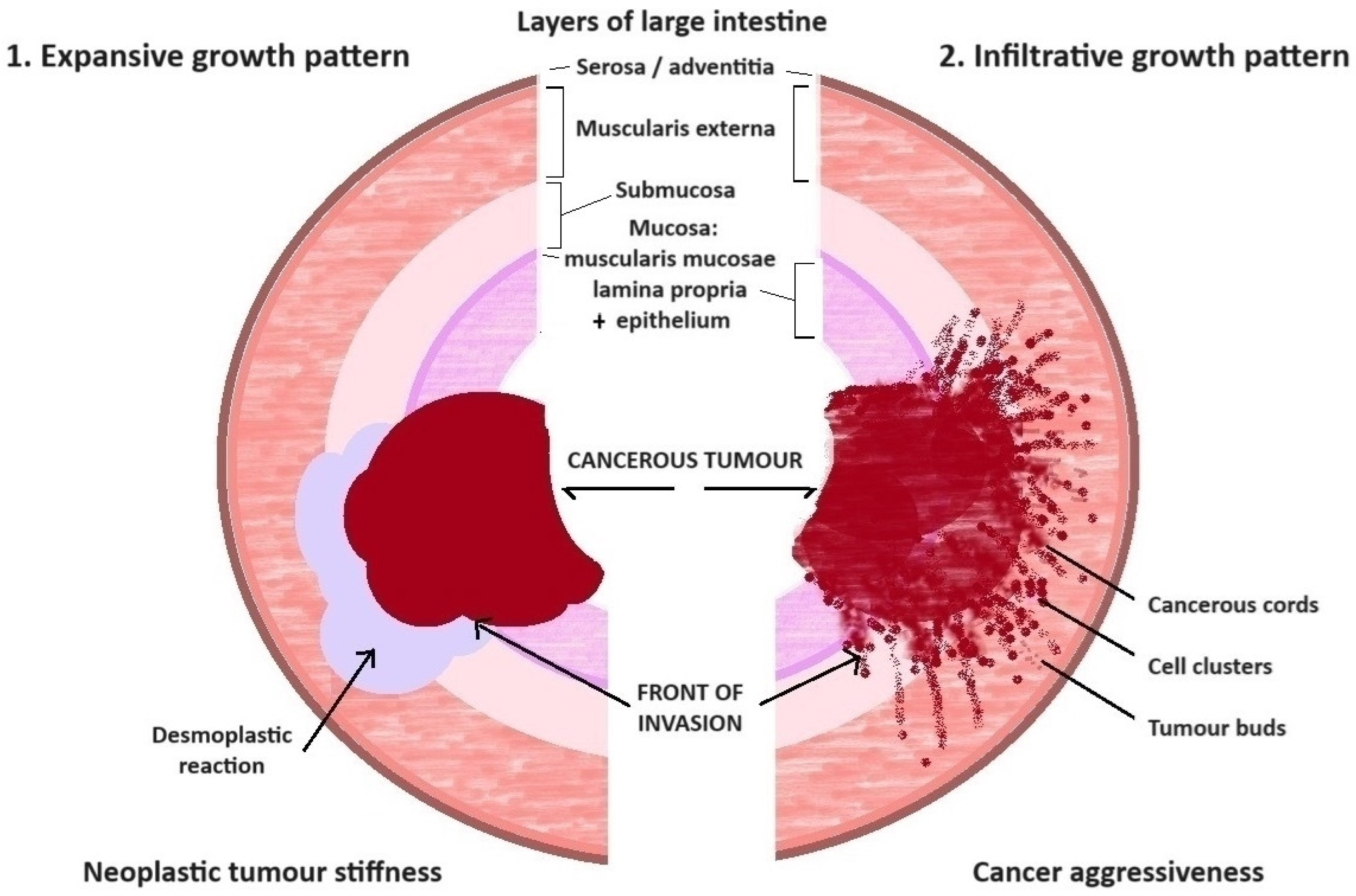 Correlating Ultrastructural Changes in the Invasion Area of Colorectal ...