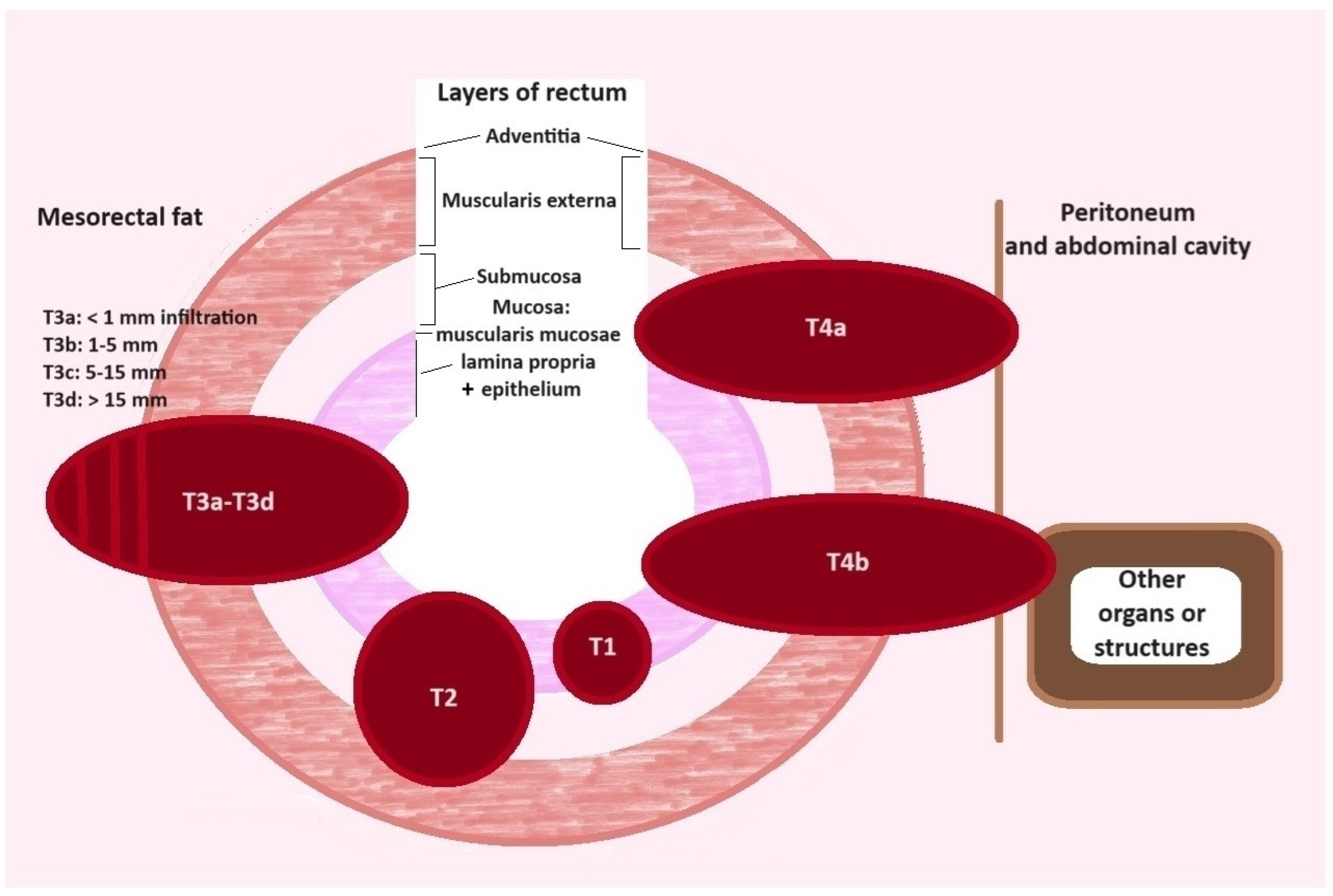 Correlating Ultrastructural Changes in the Invasion Area of Colorectal ...