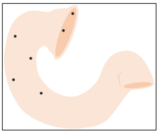 Refractory Celiac Disease: What the Gastroenterologist Should Know