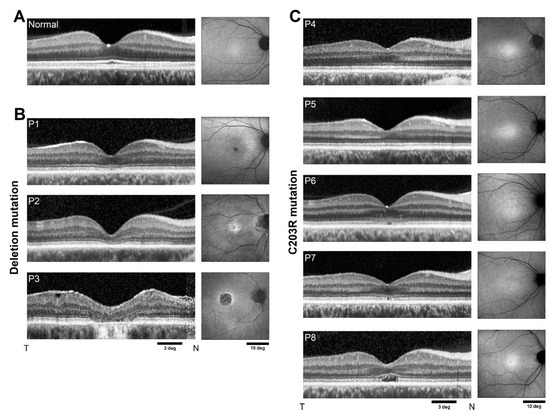 Evaluation of Retinal Structure and Visual Function in Blue Cone ...