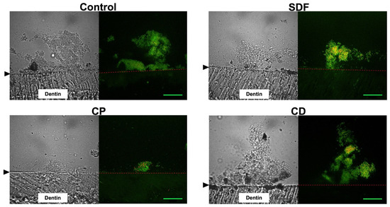 Effects of Tooth Desensitizers on Streptococcus mutans Biofilm ...