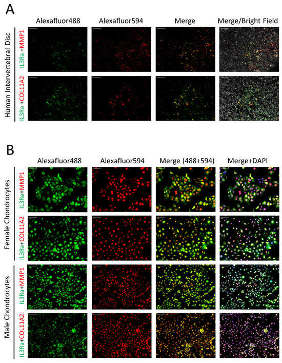 Role of IL3RA in a Family with Lumbar Spinal Stenosis