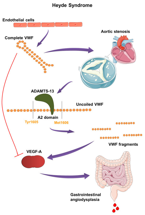 Heyde Syndrome Unveiled: A Case Report with Current Literature Review ...