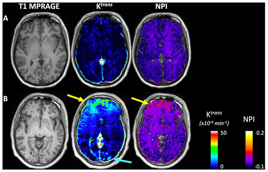 Assessing Mild Traumatic Brain Injury-Associated Blood–Brain Barrier ...