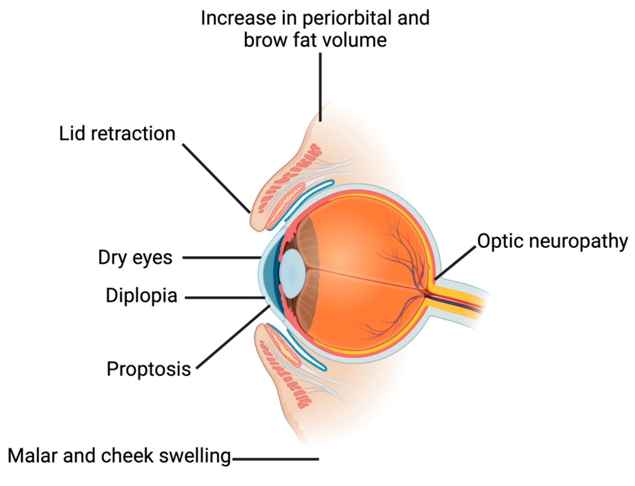 A Comprehensive Review Of Thyroid Eye Disease Pathogenesis From Immune