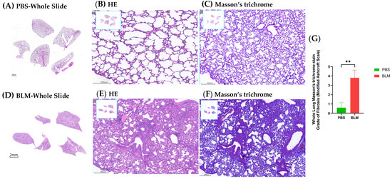 Single-Cell RNA Sequencing Reveals Monocyte-Derived Interstitial ...