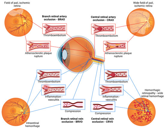 Molecular and Cellular Mechanisms Involved in the Pathophysiology of Retinal Vascular Disease ...
