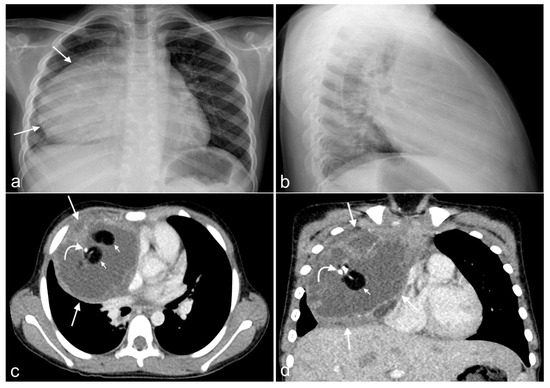 Mediastinal Teratoma with Nephroblastomatous Elements: Case Report ...