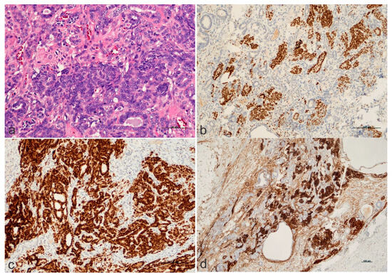 Mediastinal Teratoma with Nephroblastomatous Elements: Case Report ...