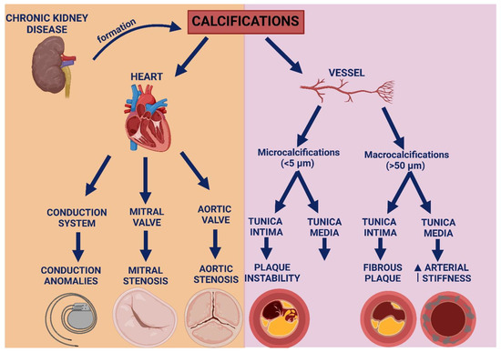 Understanding Vascular Calcification in Chronic Kidney Disease ...