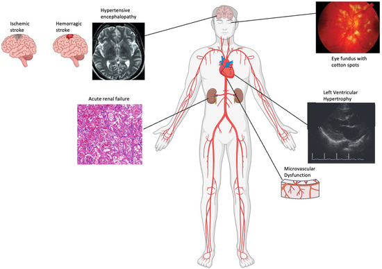 Systemic and Cardiac Microvascular Dysfunction in Hypertension