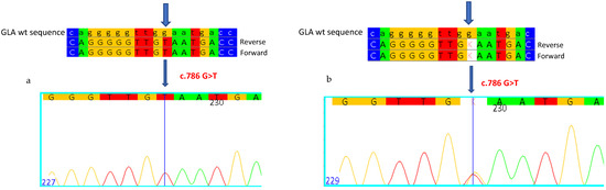 Identification of Four New Mutations in the GLA Gene Associated with ...