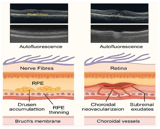 Role of Oxidative Stress and Inflammation in Age Related Macular ...