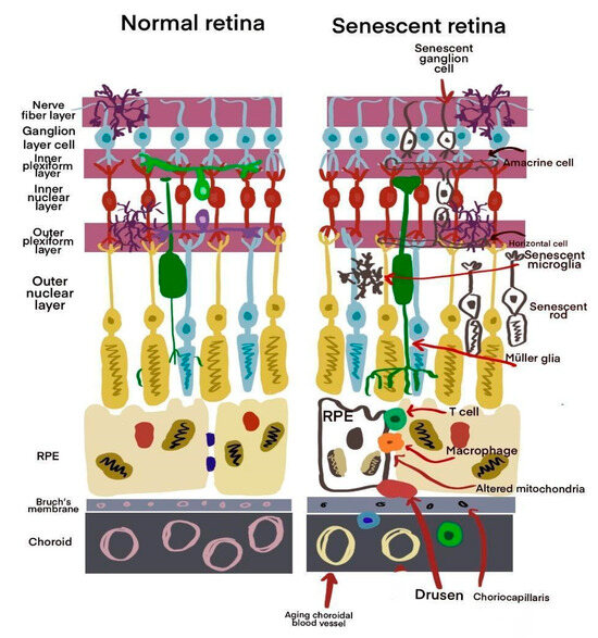 Role of Oxidative Stress and Inflammation in Age Related Macular ...