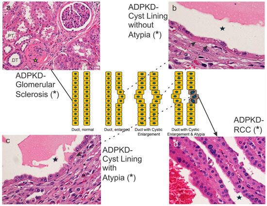 Autosomal Dominant Polycystic Kidney Disease-Related Multifocal Renal ...