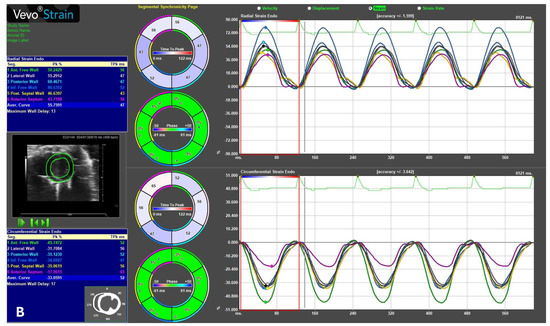 Echocardiographic Assessment of Cardiac Function in Mouse Models of ...