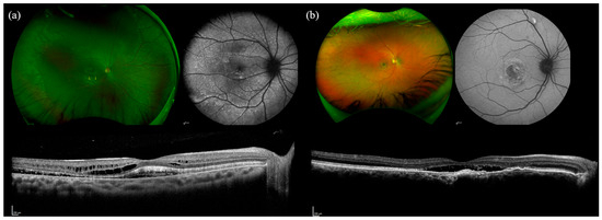 Divergent Manifestations in Biallelic Versus Monoallelic Variants of ...