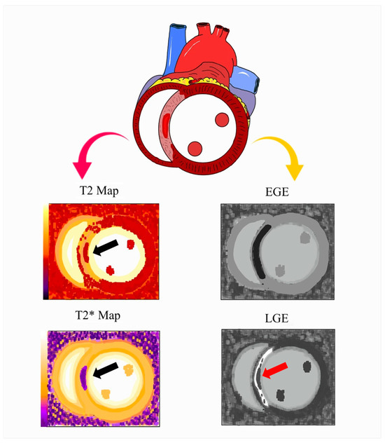 Molecular Mechanisms of Microvascular Obstruction and Dysfunction in ...
