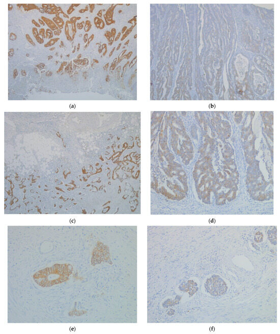 Evidence for the Prognostic Value of CDH17 Expression in Colorectal ...