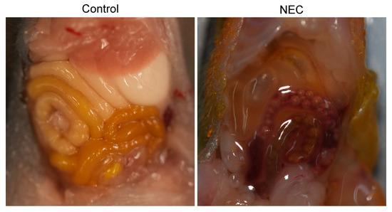 Necrotizing Enterocolitis: What’s New and What’s Next?