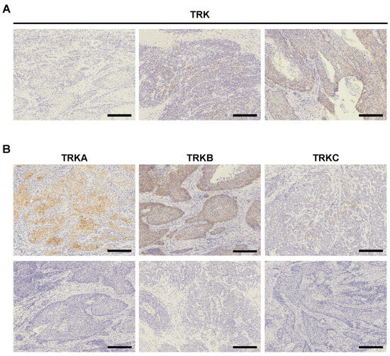 Evaluation of NTRK Fusions Detection Method in Esophageal Squamous Cell ...