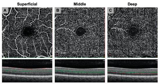 Review of OCT Angiography Findings in Diabetic Retinopathy: Insights ...
