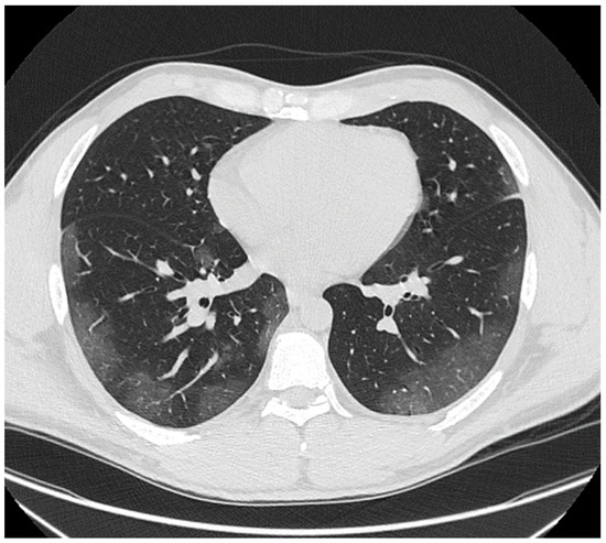A New HRCT Score for Diagnosing SARS-CoV-2 Pneumonia: A Single-Center ...
