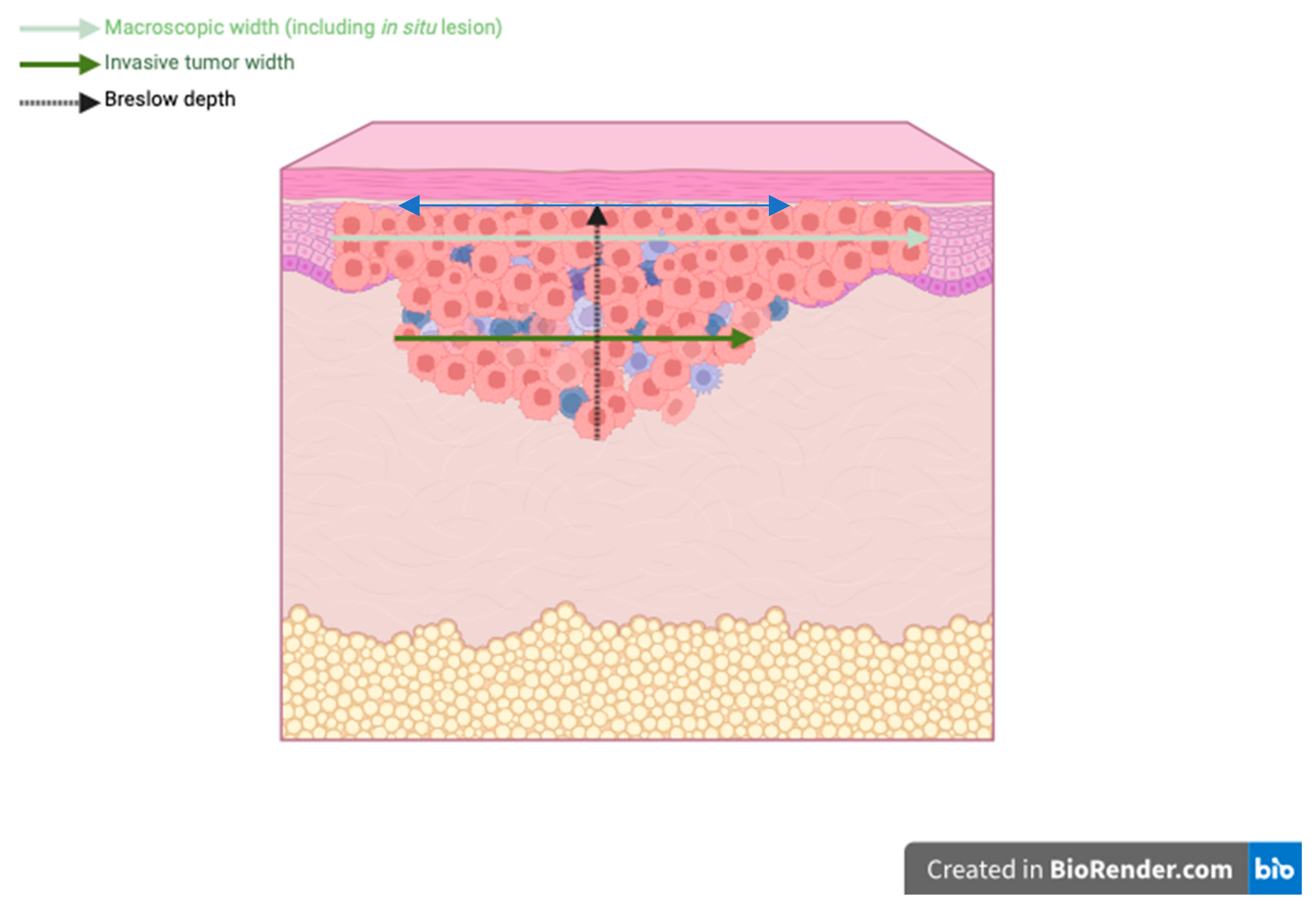 Prognostic Value of the Width of Invasion in pT3 Cutaneous Melanomas