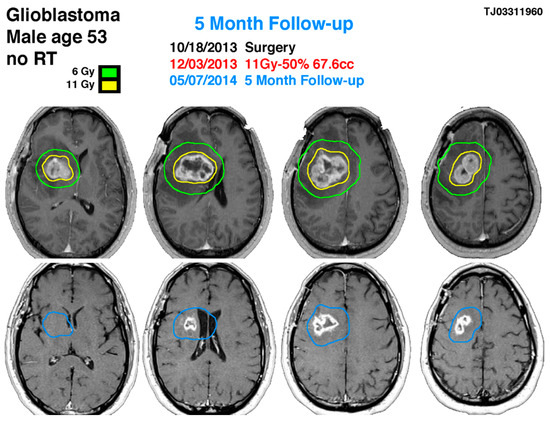 Assessment of Gamma Knife Stereotactic Radiosurgery as an Adjuvant ...