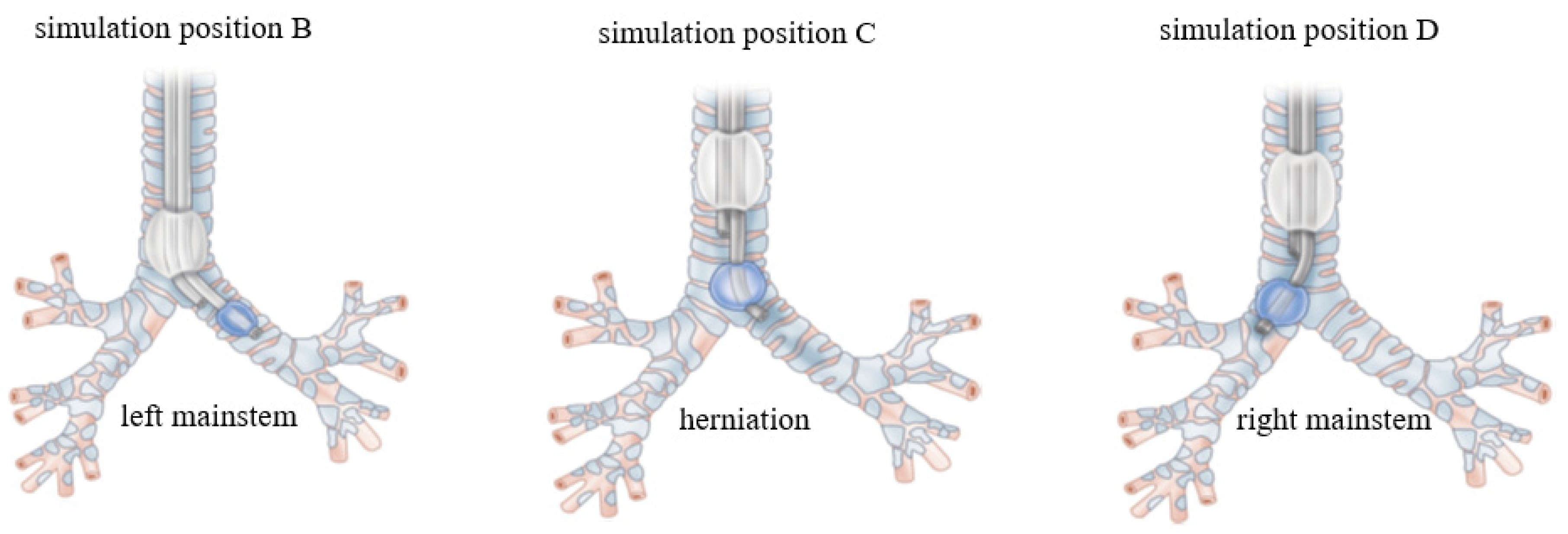 Management of Malpositioned Double-Lumen Tubes: A Simulation-Based ...
