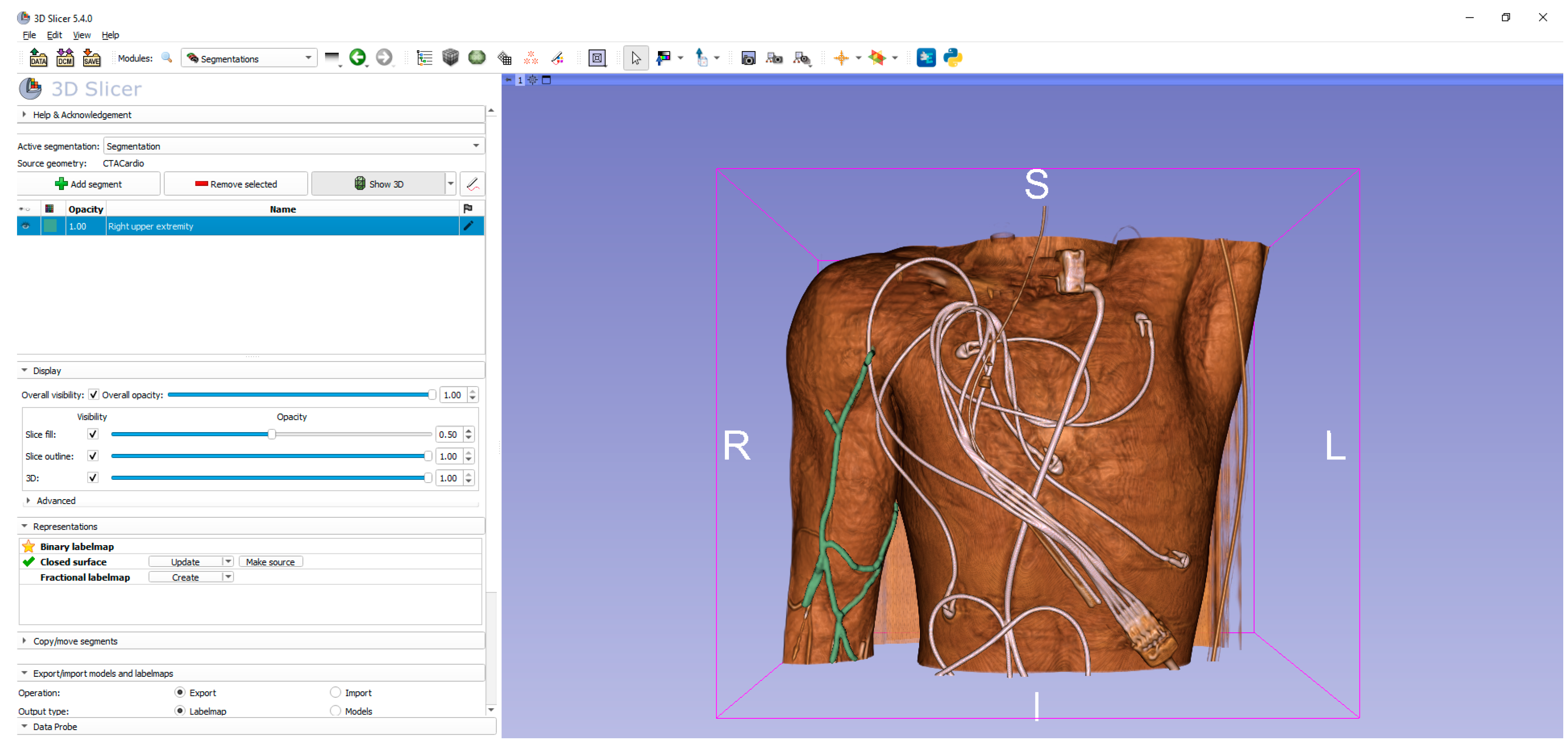 Simulation-Based Medical Education: 3D Printing and the Seldinger Technique