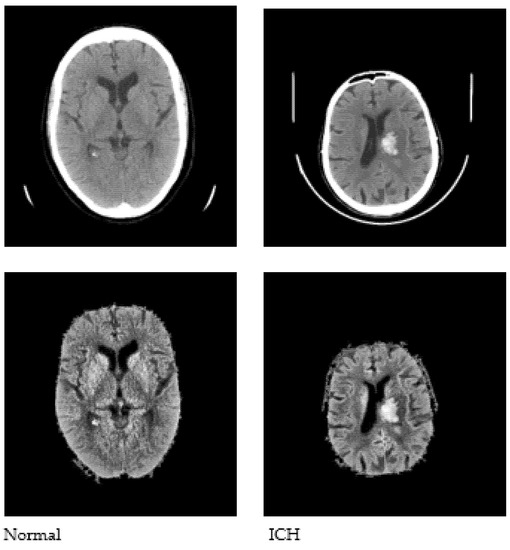 Informatics | Free Full-Text | Automated Intracranial Hematoma ...