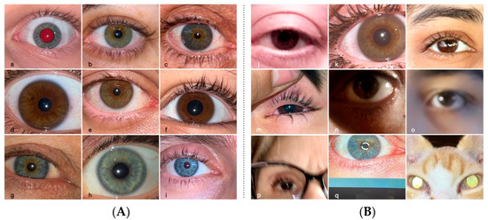 Deep Learning-Based Analysis of Ocular Anterior Segment Diseases from ...