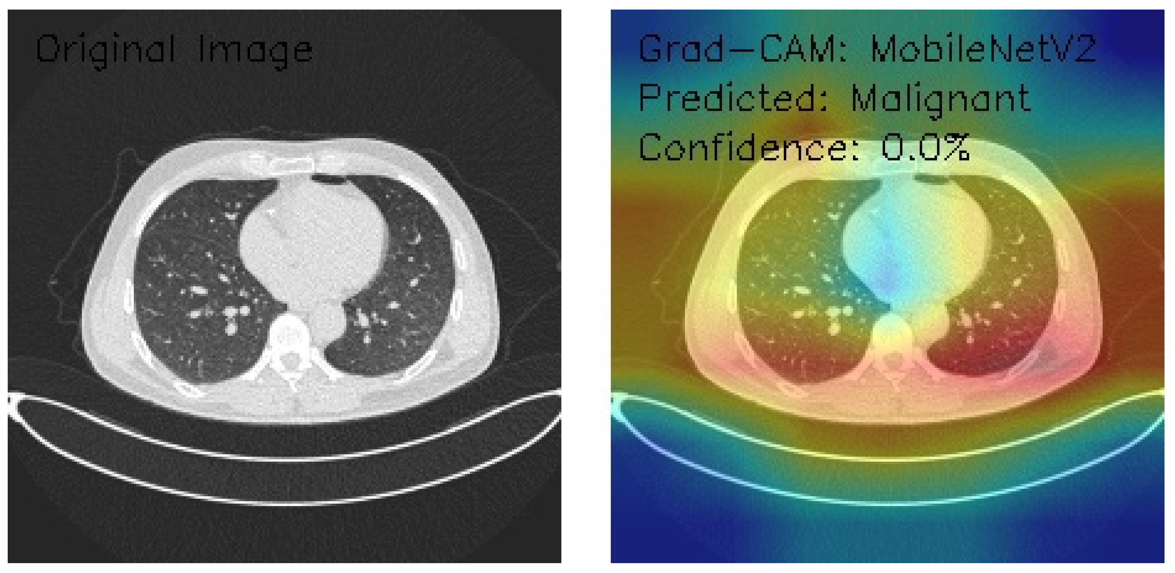 AI-Powered Lung Cancer Detection: Assessing VGG16 and CNN Architectures for CT Scan Image ...